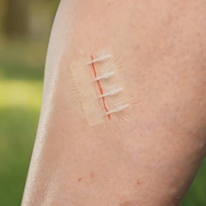 Zip Stitch: Easy wound closure strips eliminate the need for stitches