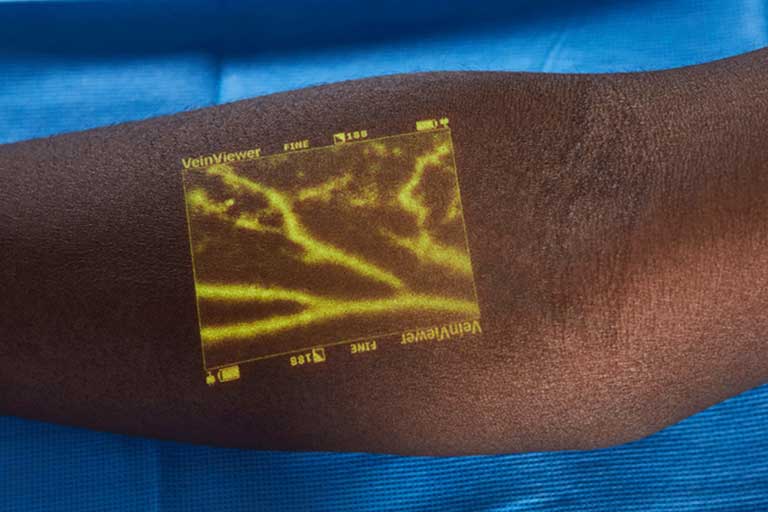 The VeinViewer uses infrared light to help nurses find veins on the ...